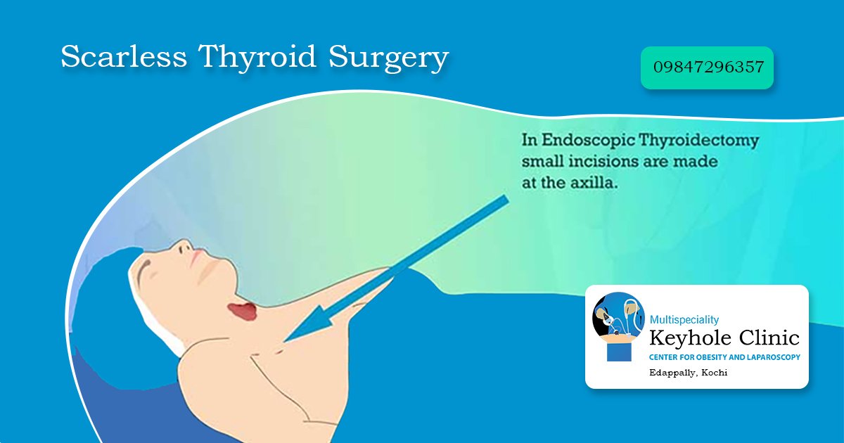 Thyroid Surgery in Kerala | Endoscopic Thyroidectomy