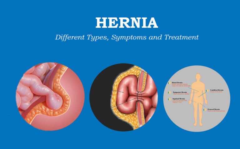 Hernia- Types, Symptoms, and Treatment - Keyhole Clinic Kochi
