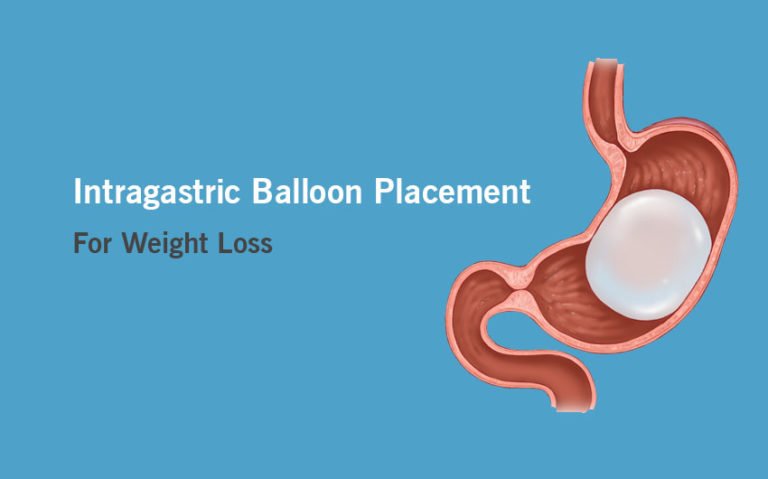 Intragastric Balloon Placement for Weight Loss - Keyhole Clinic Kochi