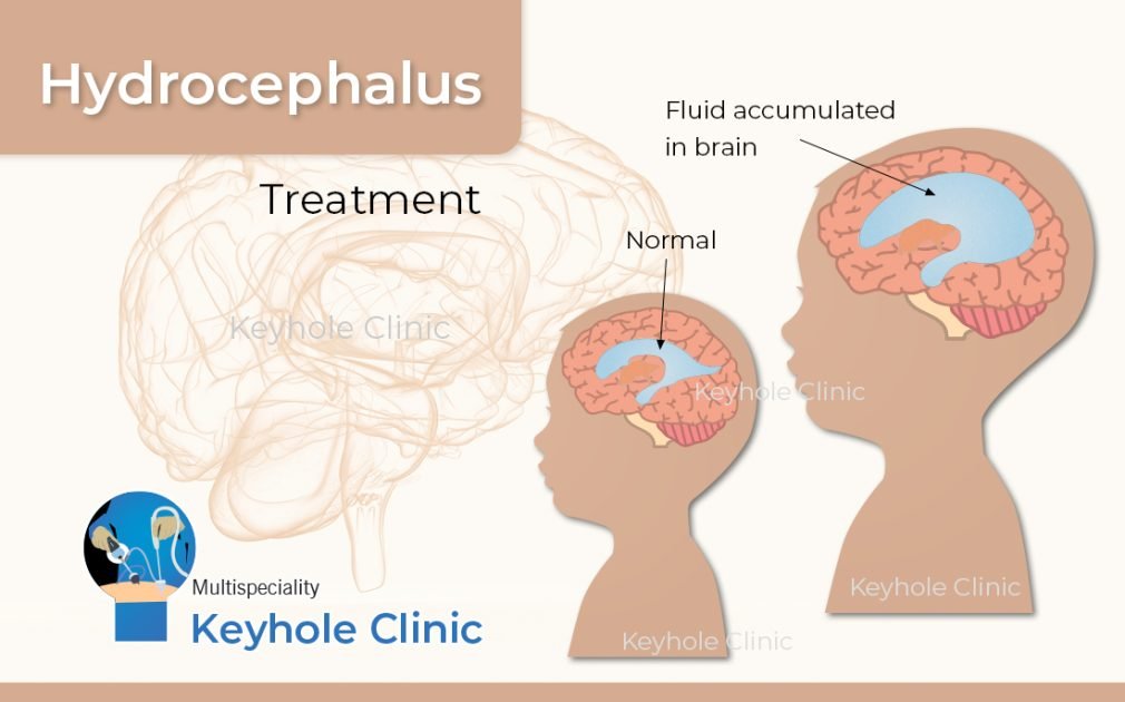 Hydrocephalus Treatment in Kochi - Dr. Sudish Karunakaran